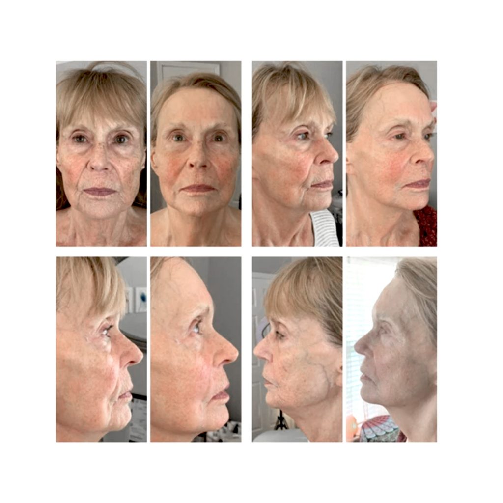 At Home Ultrasound Facial Tool by AOMED Time Master Pro